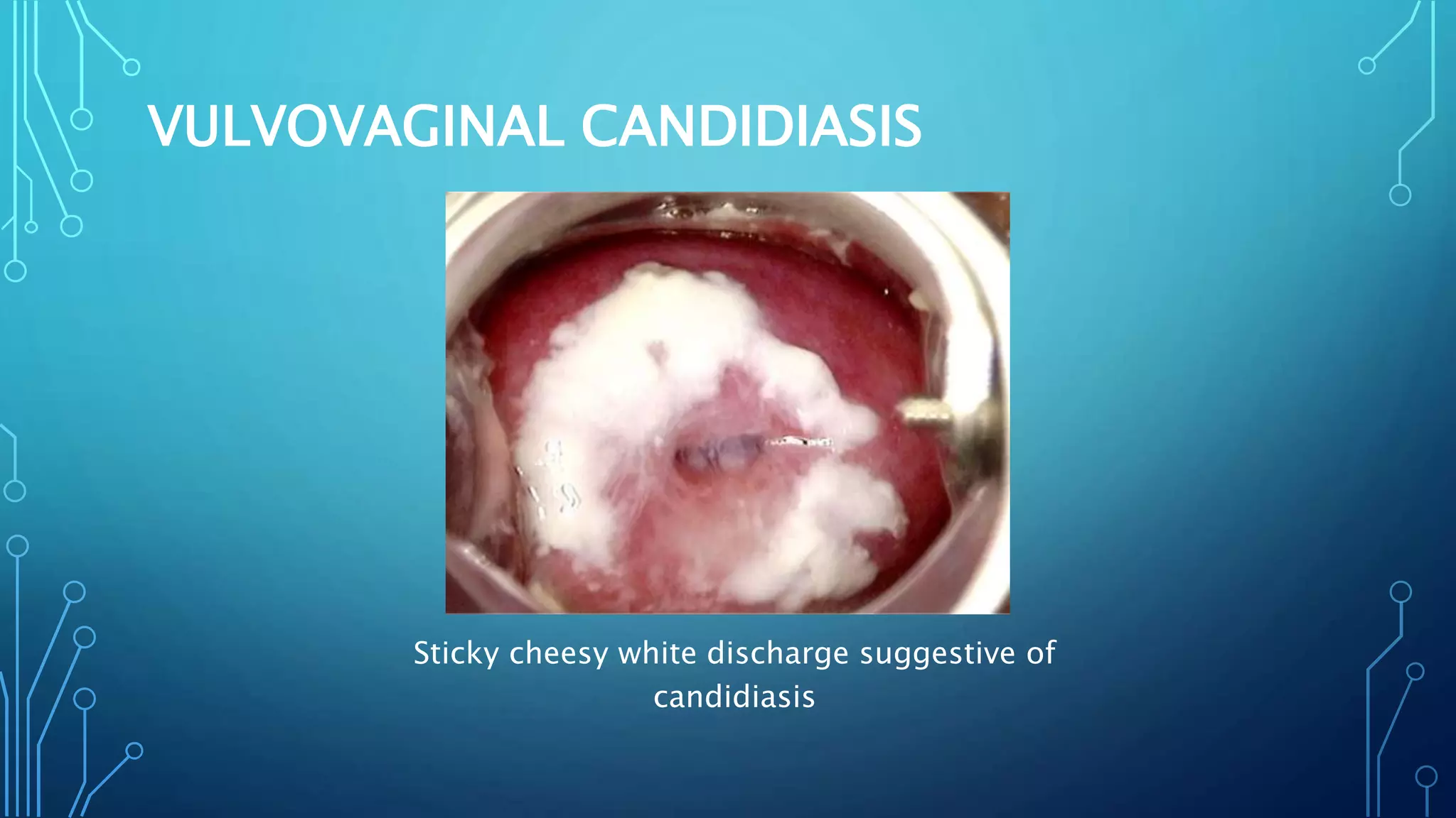 Vaginal Discharge | PPTX