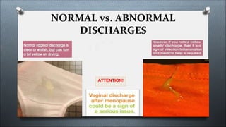 Abnormal Vaginal Discharge