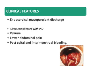 Mucopurulent Vaginal Discharge