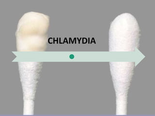 Chlamydia Vaginal Discharge