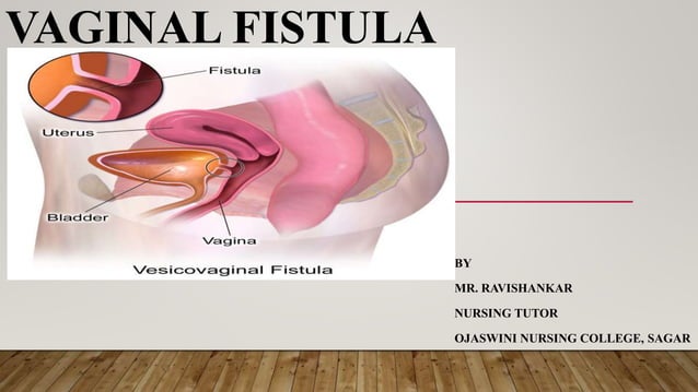 Vaginal fistula (1).pdf