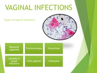 Vaginal infection and infertility | PPTX