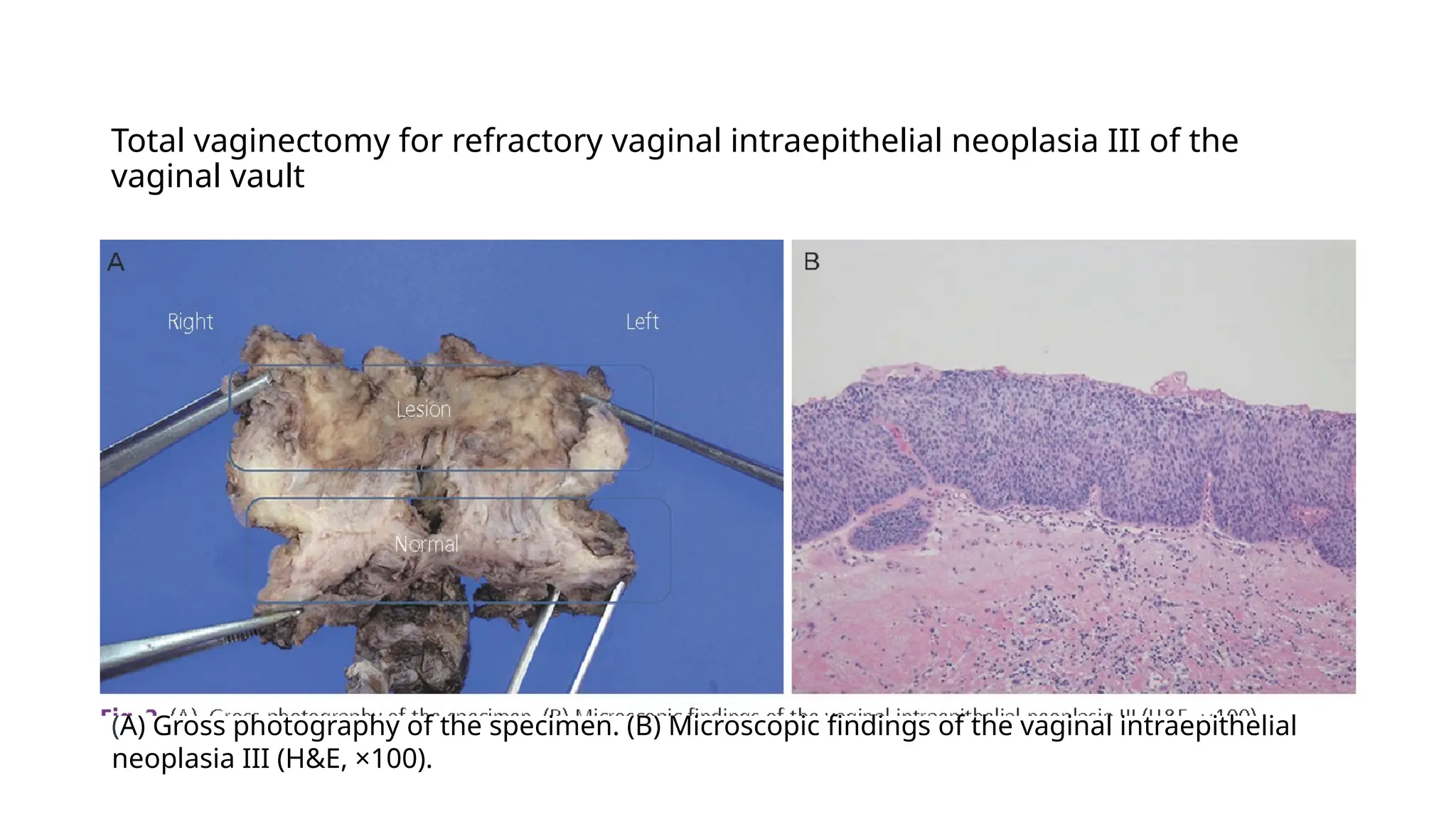 VAGINAL INTRAEPITHELIAL NEOPLASIAAAAAAAA | PPTX