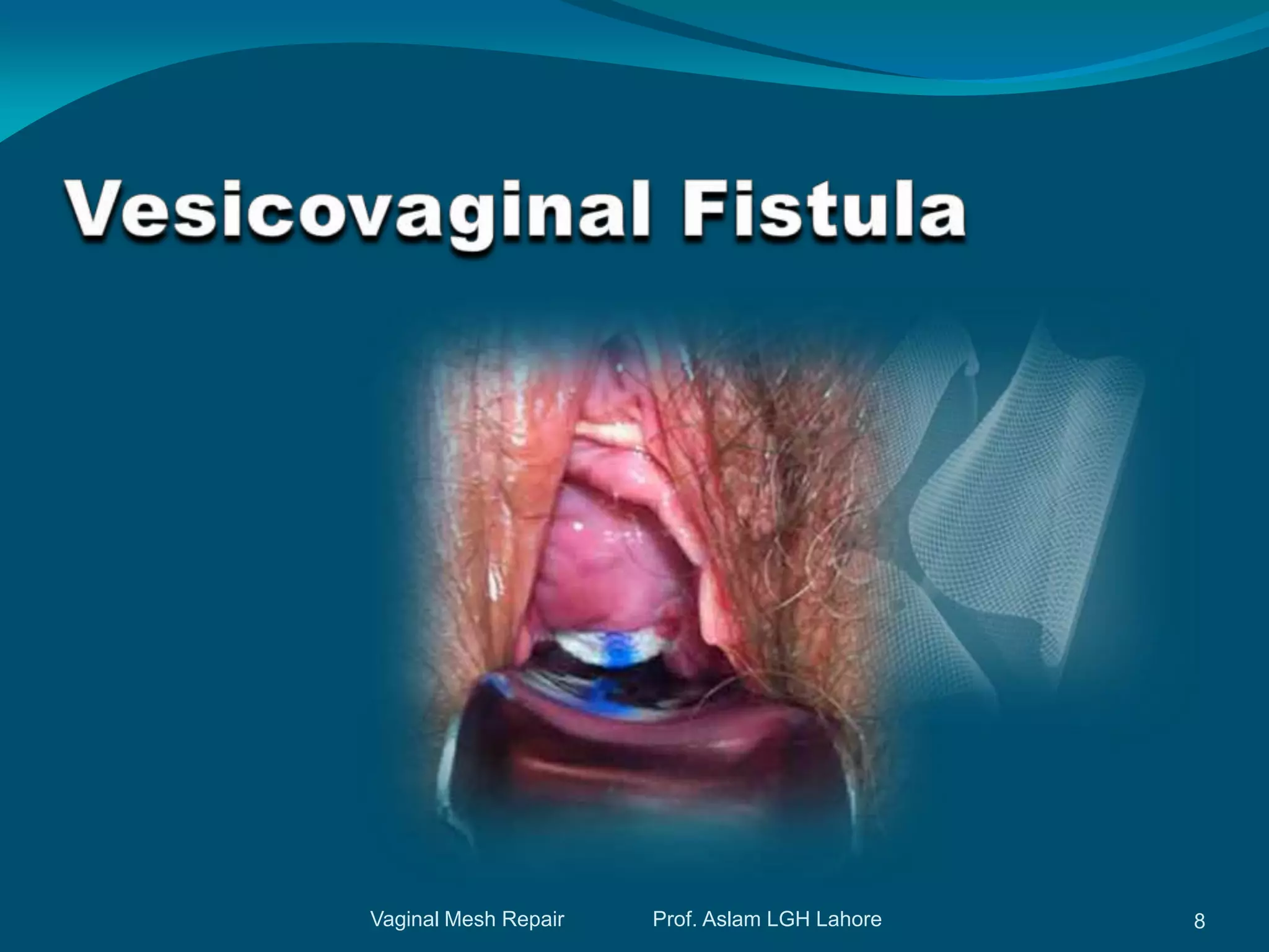 Vaginal Mesh Repair Ppt