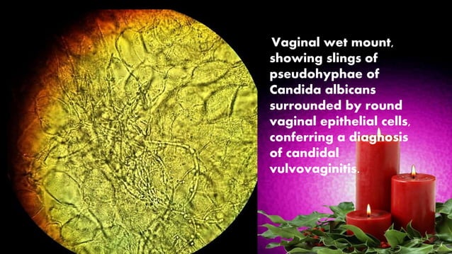 Vaginal thrush | PPTX | Skin and Dermatology | Diseases and Conditions
