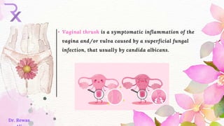 vaginal thrush presentation by Dr. Rewas Ali | PPTX