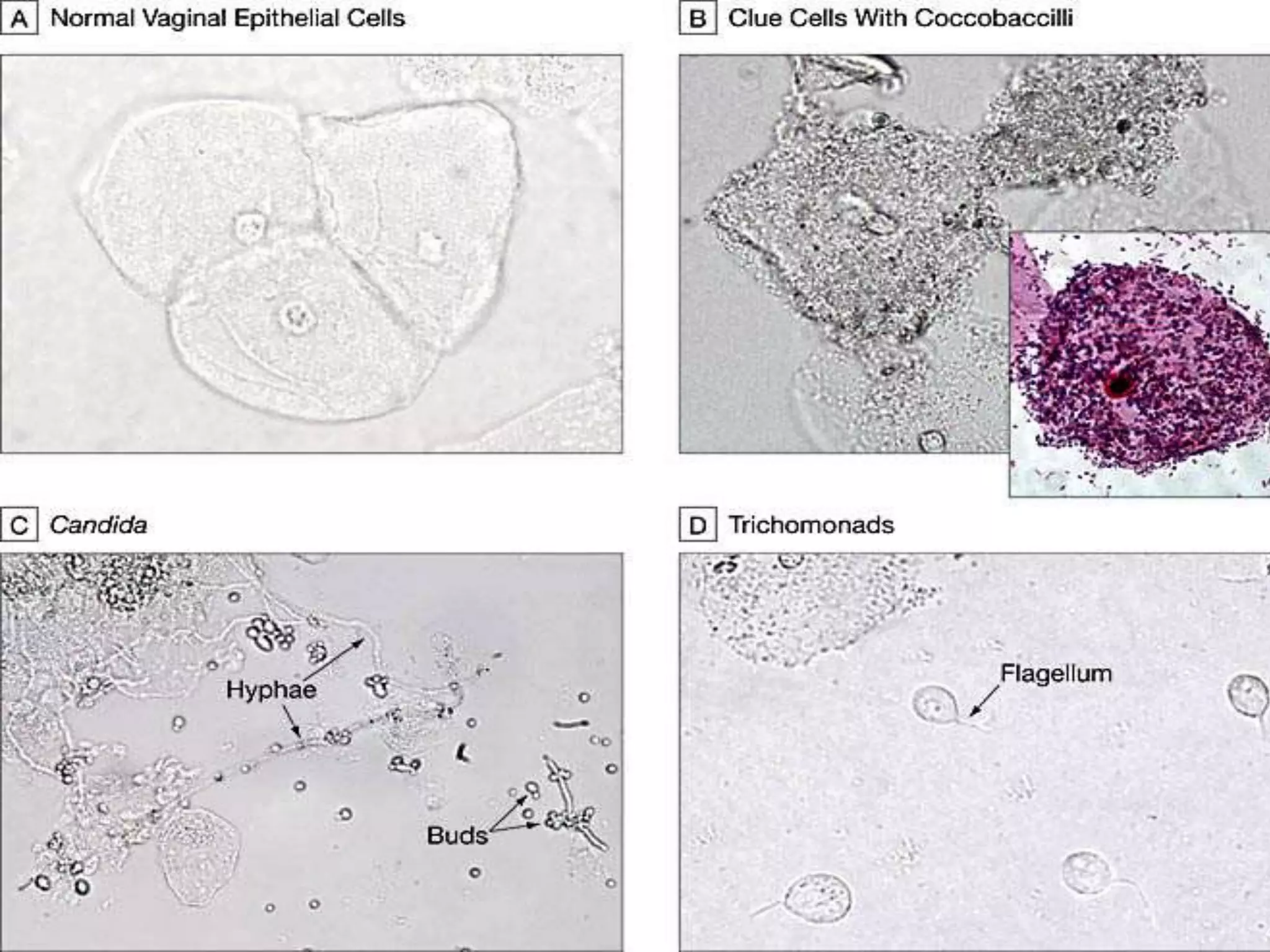 Vaginitis/Colpitis | PPT