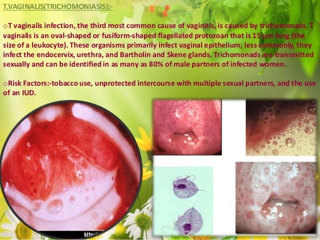 Vaginitis/Colpitis