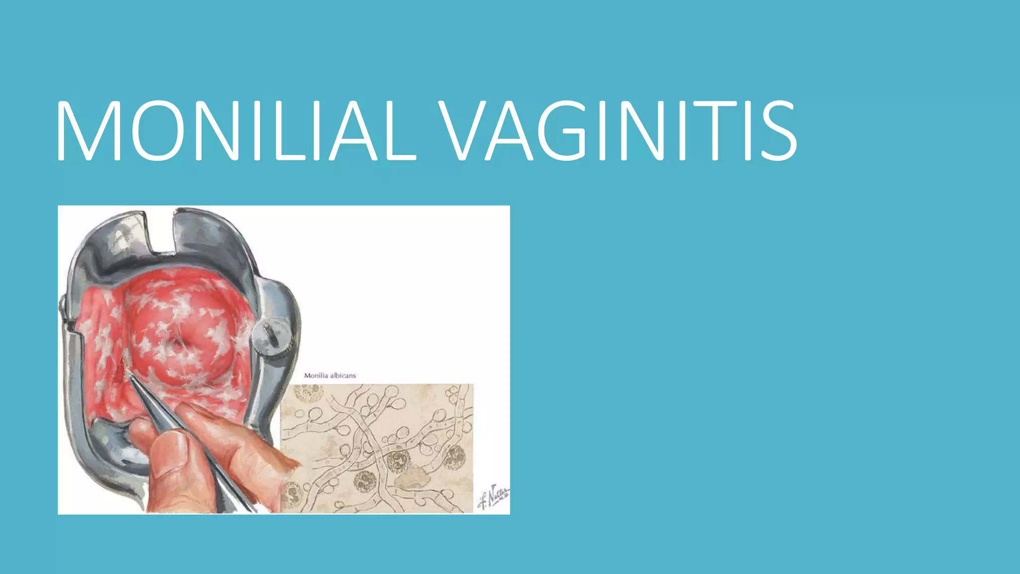 Vaginitis | PPTX