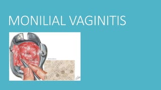 Vaginitis | PPTX