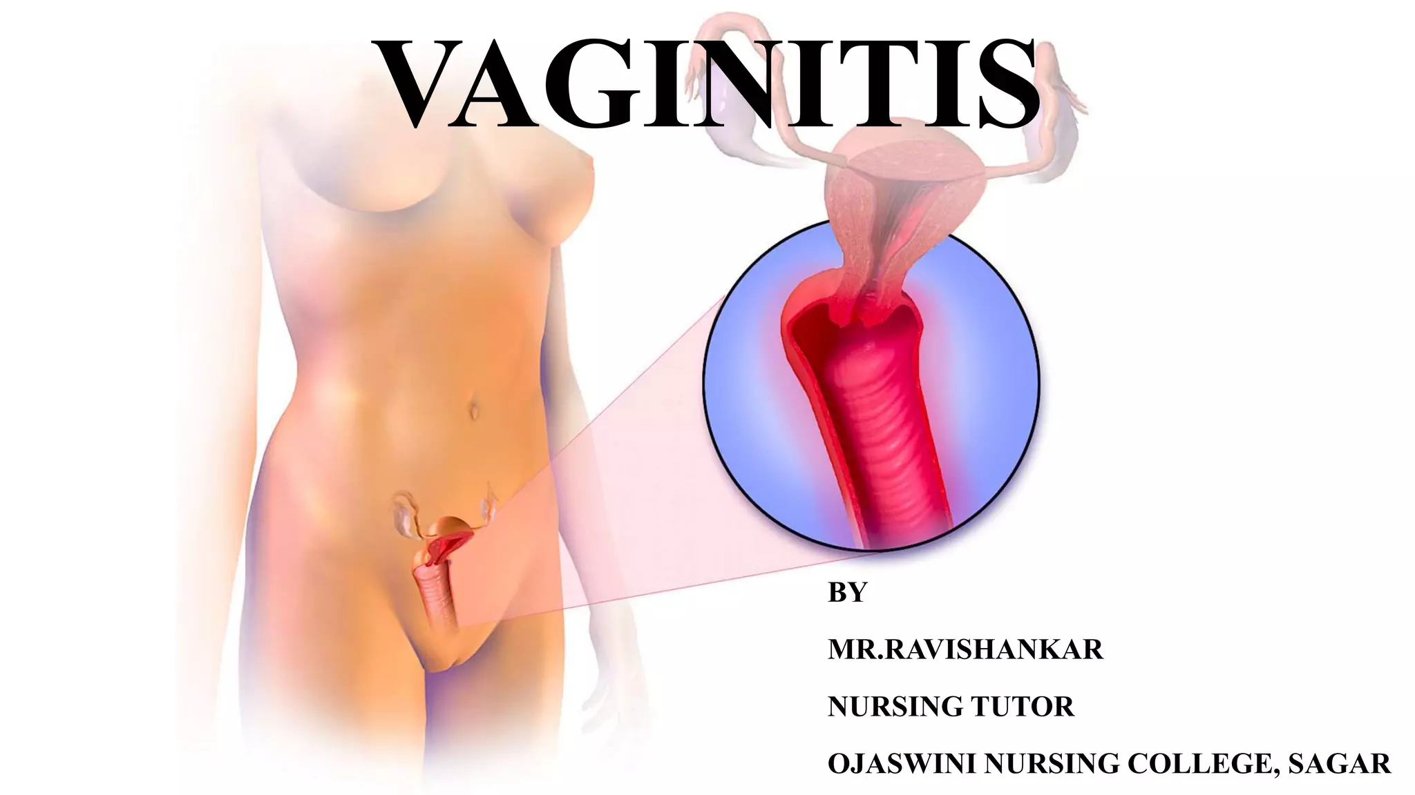 vaginitis.pdf
