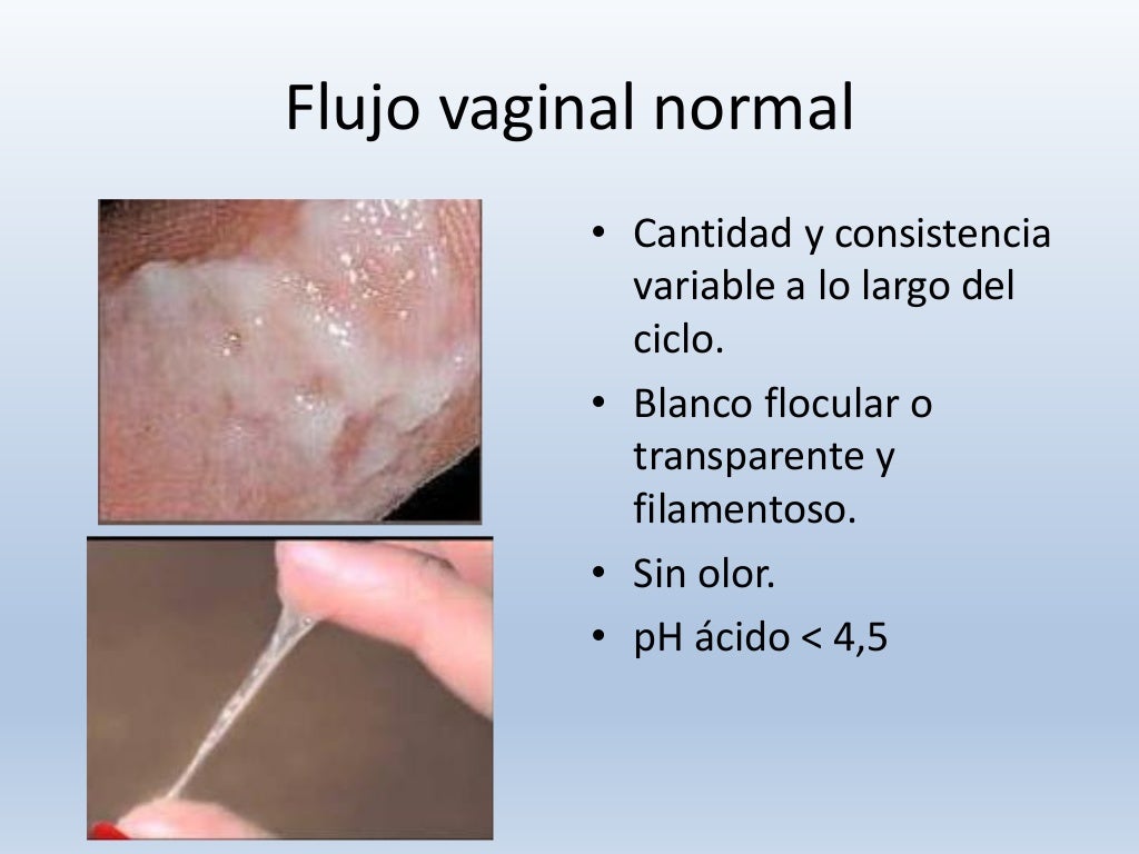 Vaginitis En Atención Primaria Por Fernando Naranjo