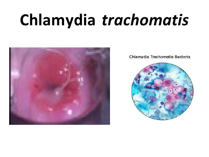 Vaginitis Vaginosis Epi