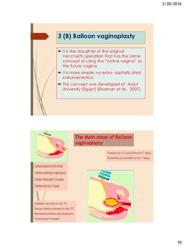 Vaginoplasty An Update And Future Concern