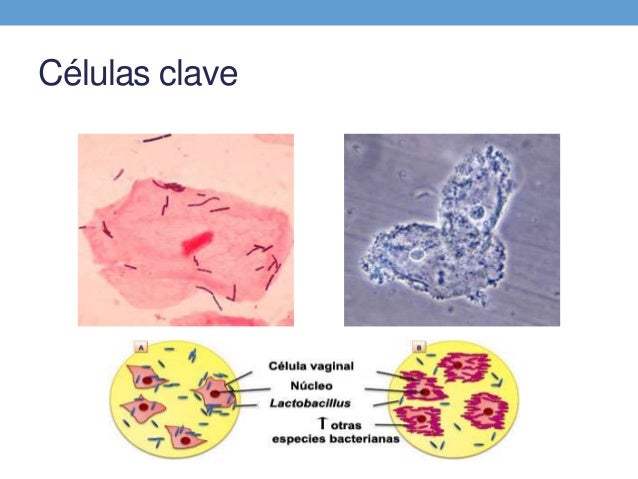 Vaginosis bacteriana ujat
