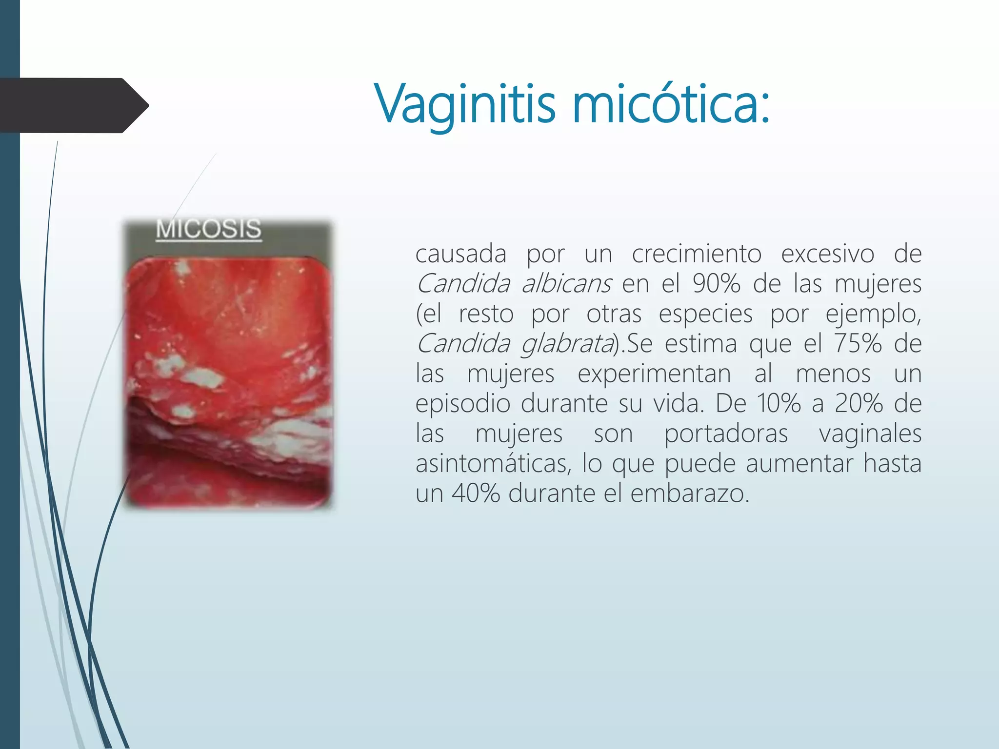 Vaginosis en el embarazo | PPTX