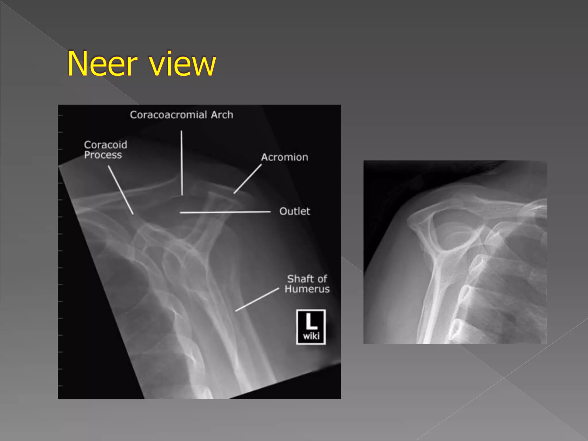 Shoulder x-ray | PPTX