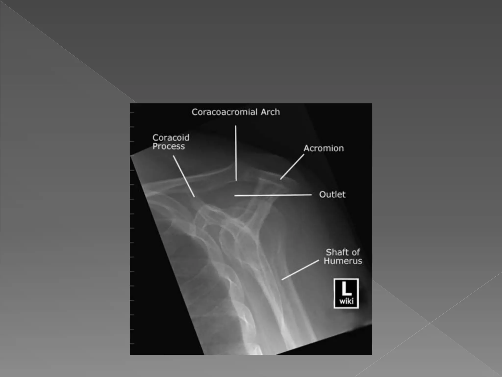 Shoulder x-ray | PPTX