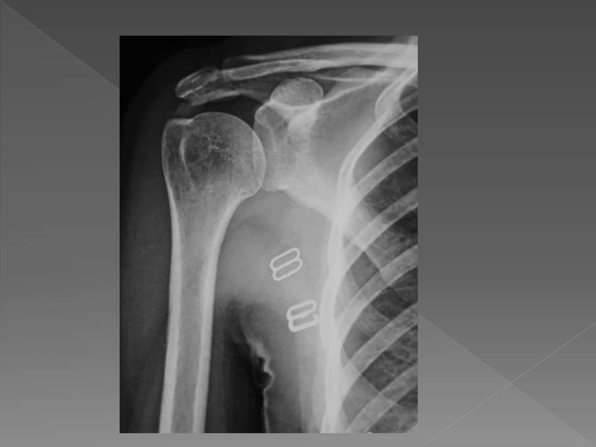 Shoulder x-ray | PPTX | Death, Injury, or Military Conflict | Sensitive ...