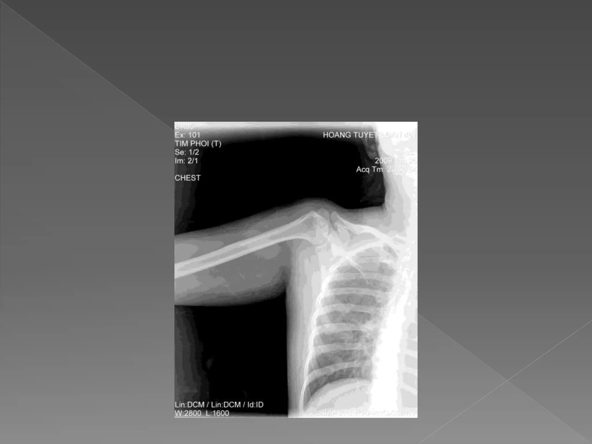 Shoulder x-ray | PPTX