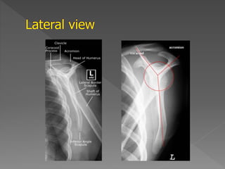 Shoulder x-ray | PPTX