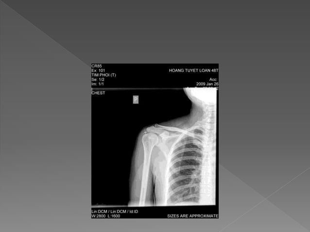 Shoulder x-ray | PPTX | Death, Injury, or Military Conflict | Sensitive ...