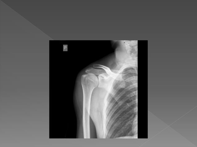 Shoulder x-ray | PPTX | Death, Injury, or Military Conflict | Sensitive ...