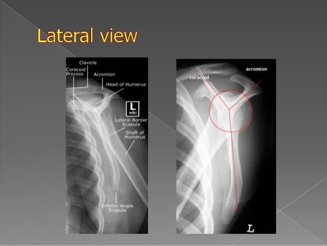 Shoulder x-ray