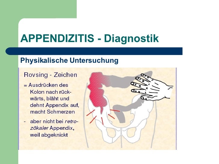 Vakbélgyulladás, appendicitis