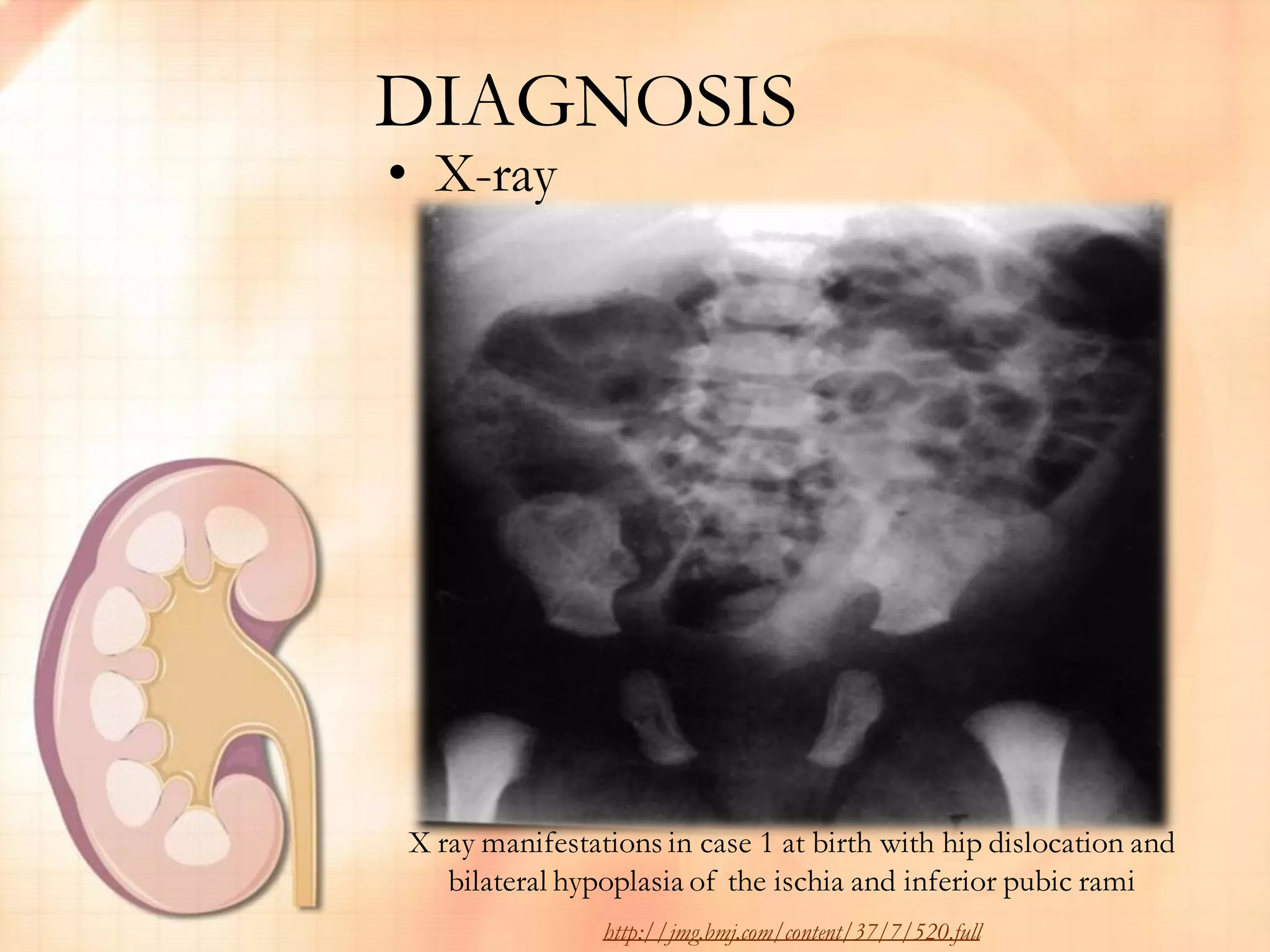 Renal Hypoplasia FINAL OUTPUT by Nica Valencia | PDF