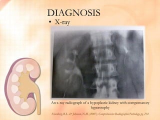 Renal Hypoplasia FINAL OUTPUT by Nica Valencia | PDF