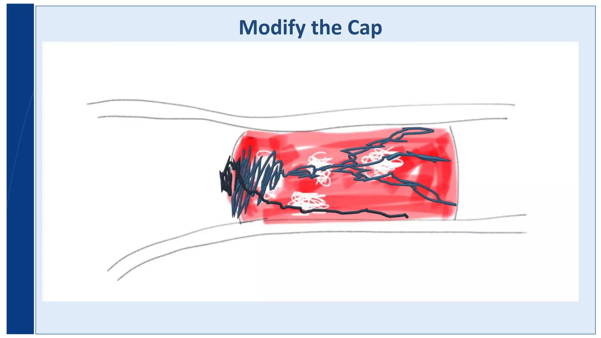 Rapid fire Tipps and Tricks – 5 min: What do do if ... you cannot cross the proximal cap | PPTX ...