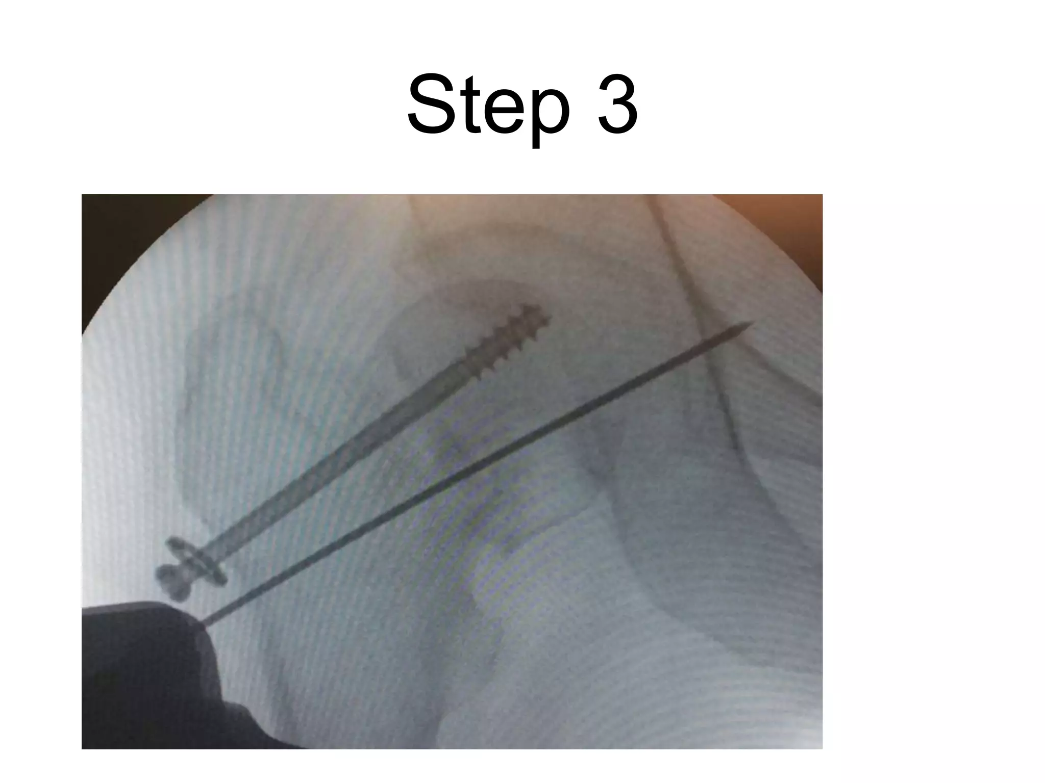 Valgus or abduction osteotomy for Non union Femur | PPTX