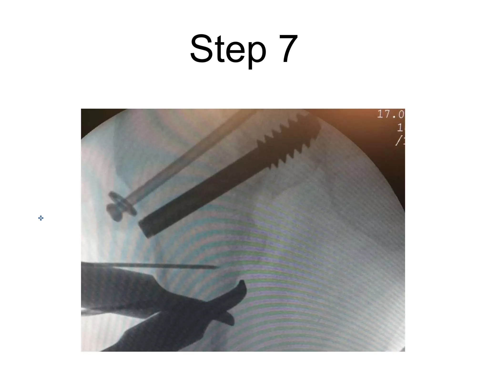 Valgus or abduction osteotomy for Non union Femur | PPTX