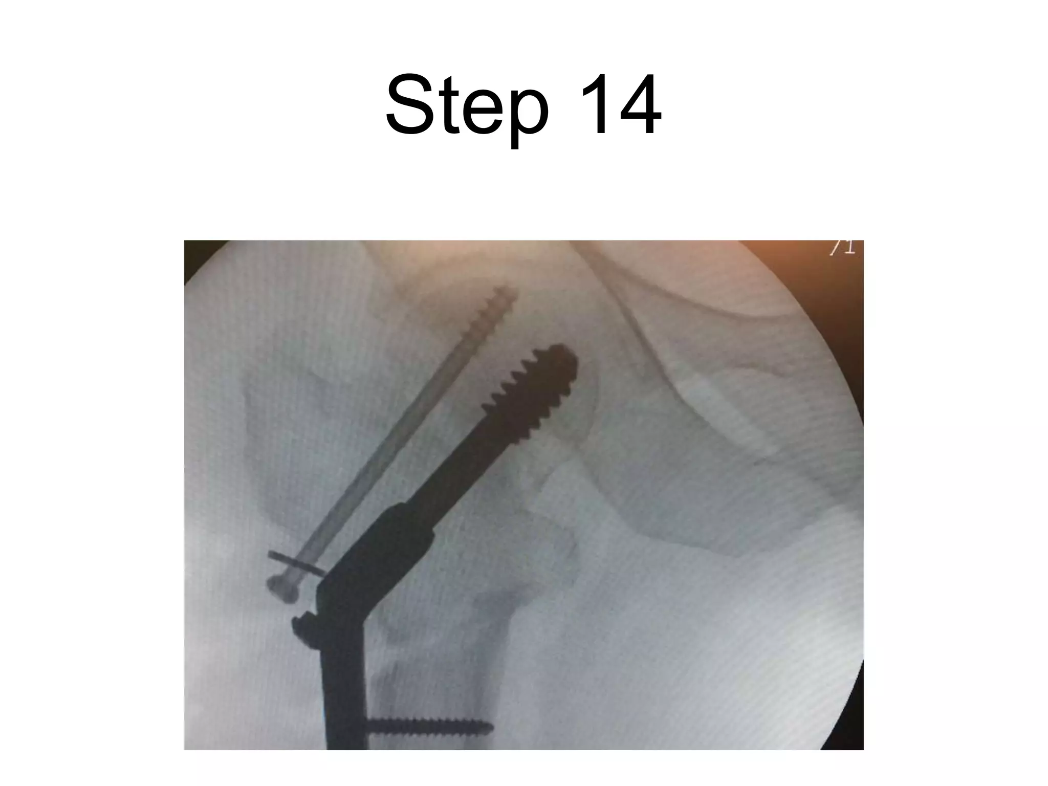 Valgus or abduction osteotomy for Non union Femur | PPTX