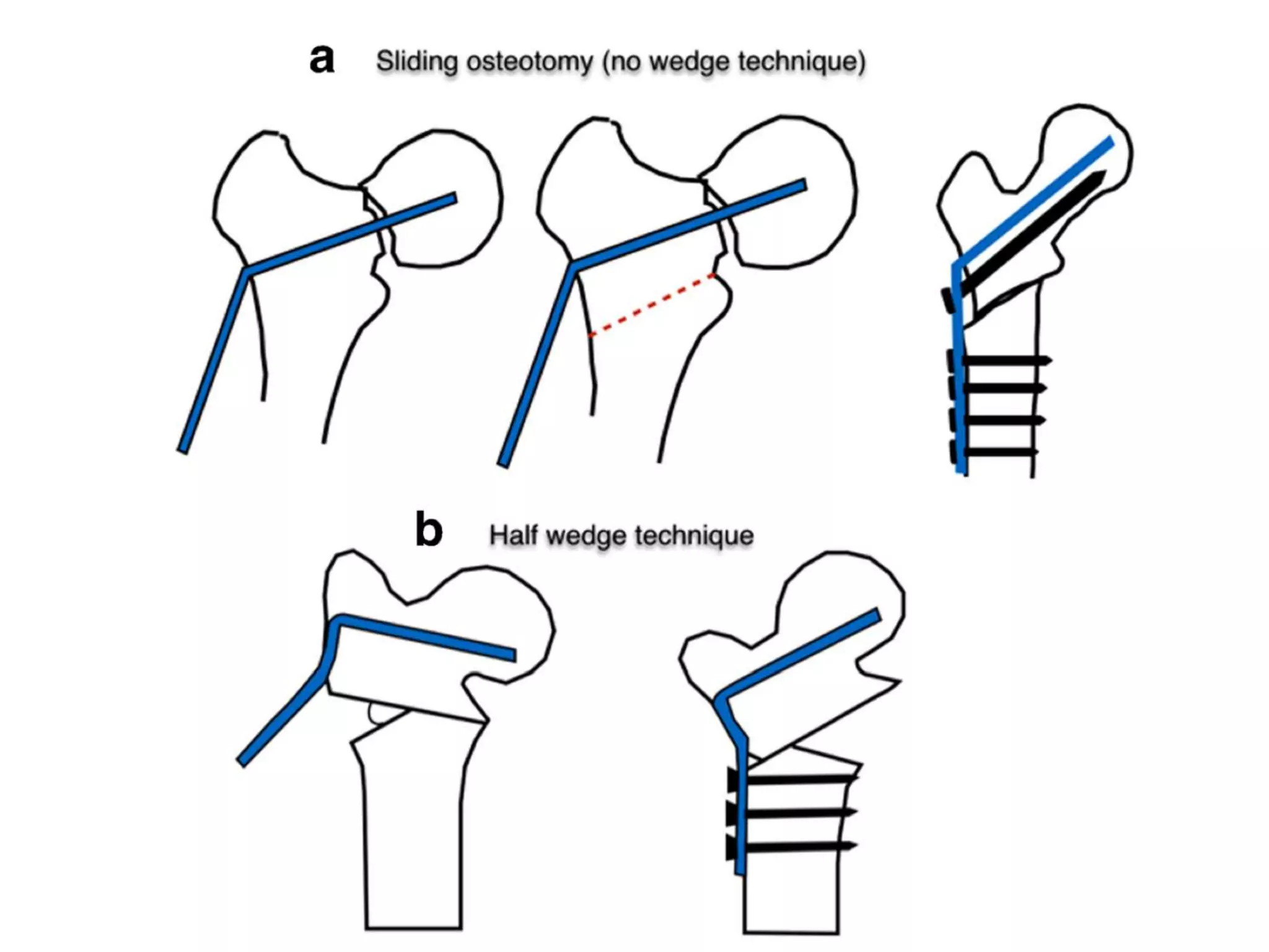 Valgus or abduction osteotomy for Non union Femur | PPTX