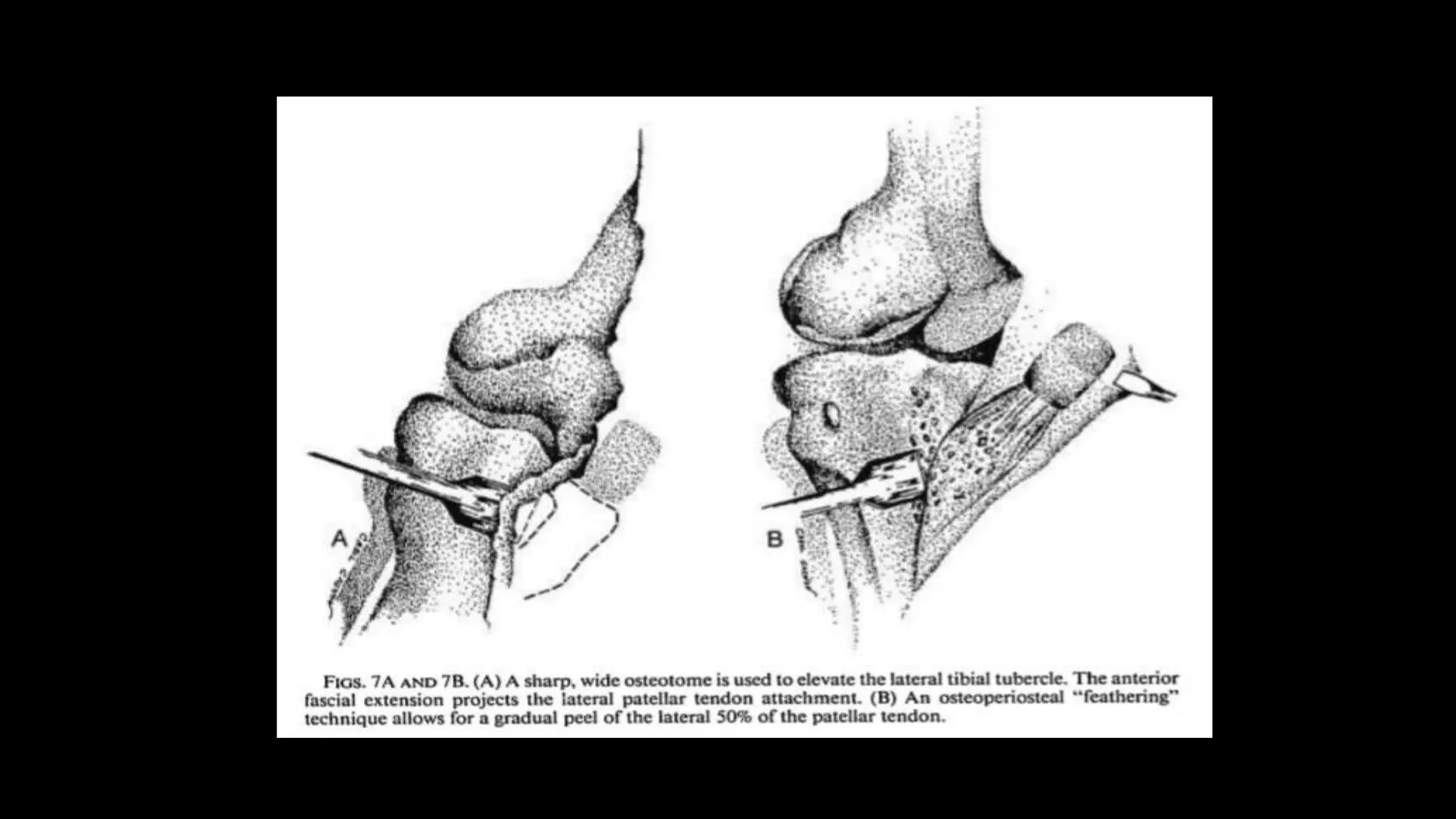 Valgus total knee arthroplasty | PPTX