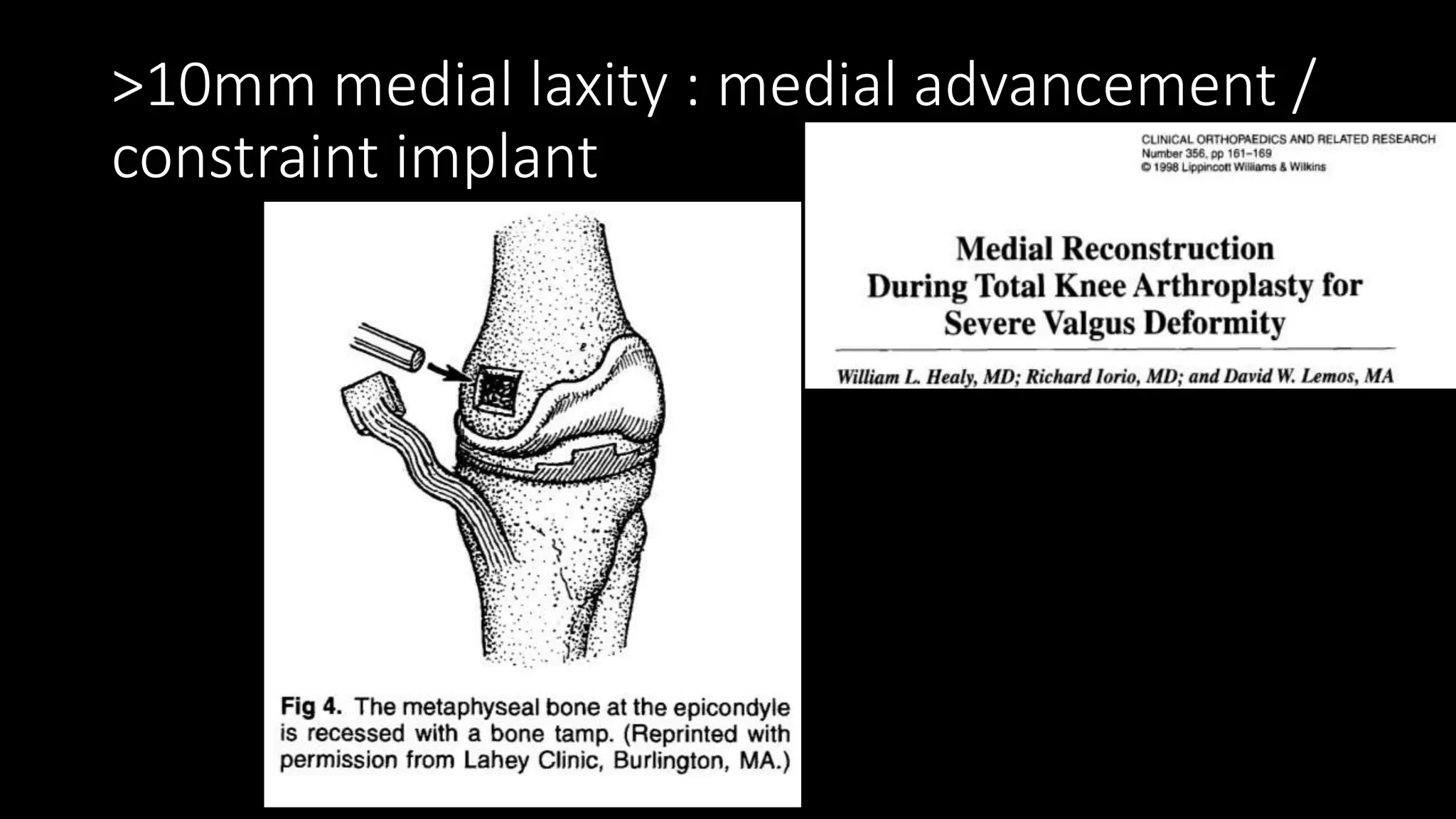 Valgus total knee arthroplasty | PPTX