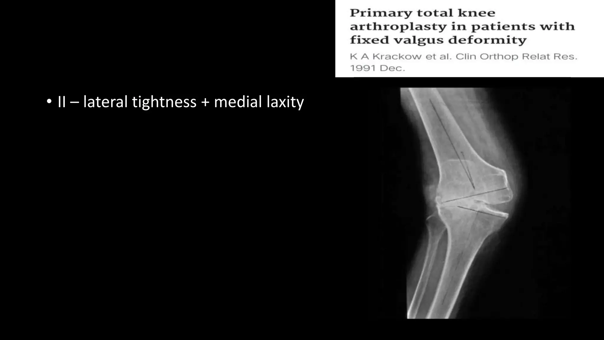 Valgus total knee arthroplasty | PPTX