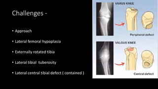 Valgus total knee arthroplasty | PPTX