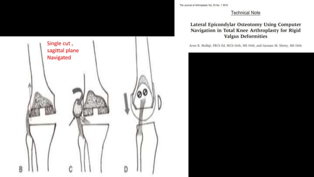 Valgus total knee arthroplasty | PPTX | Death, Injury, or Military ...