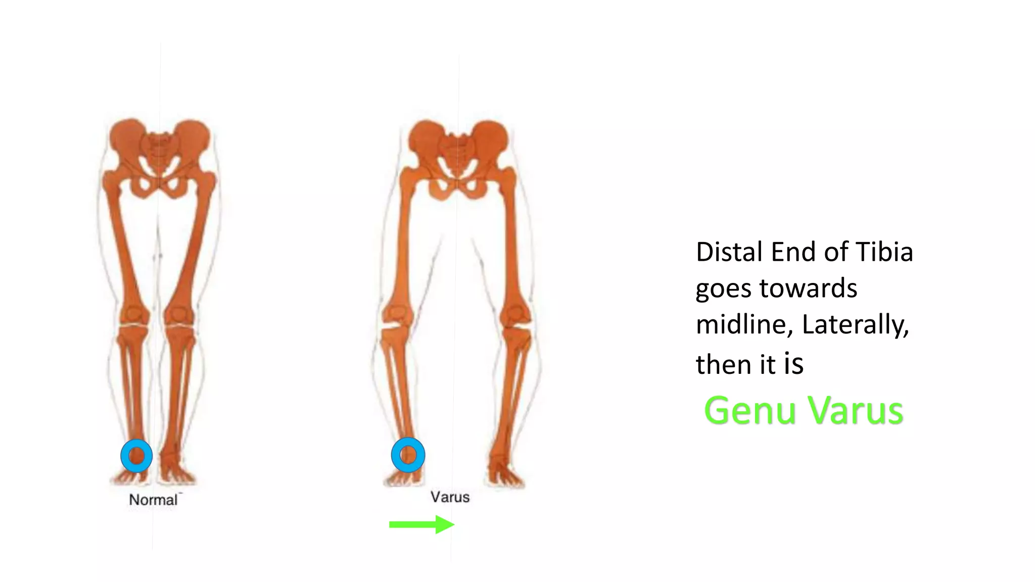 Valgus vs. Varus | PPTX