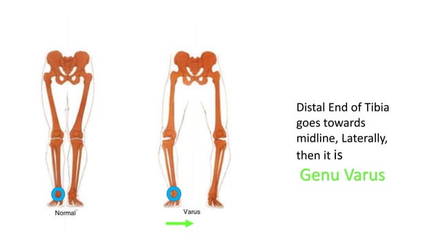 Valgus vs. Varus | PPTX