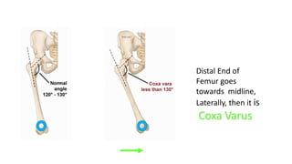 Valgus vs. Varus | PPT