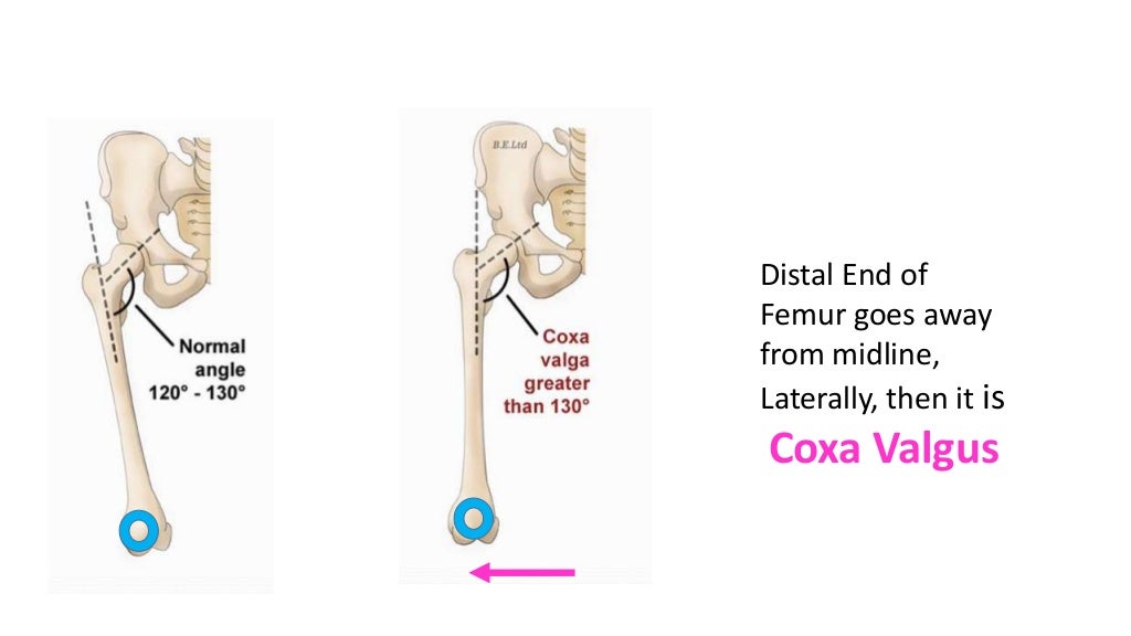 Valgus vs. Varus