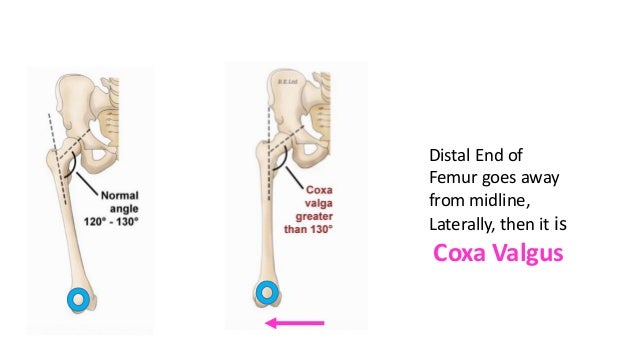 Valgus vs. Varus