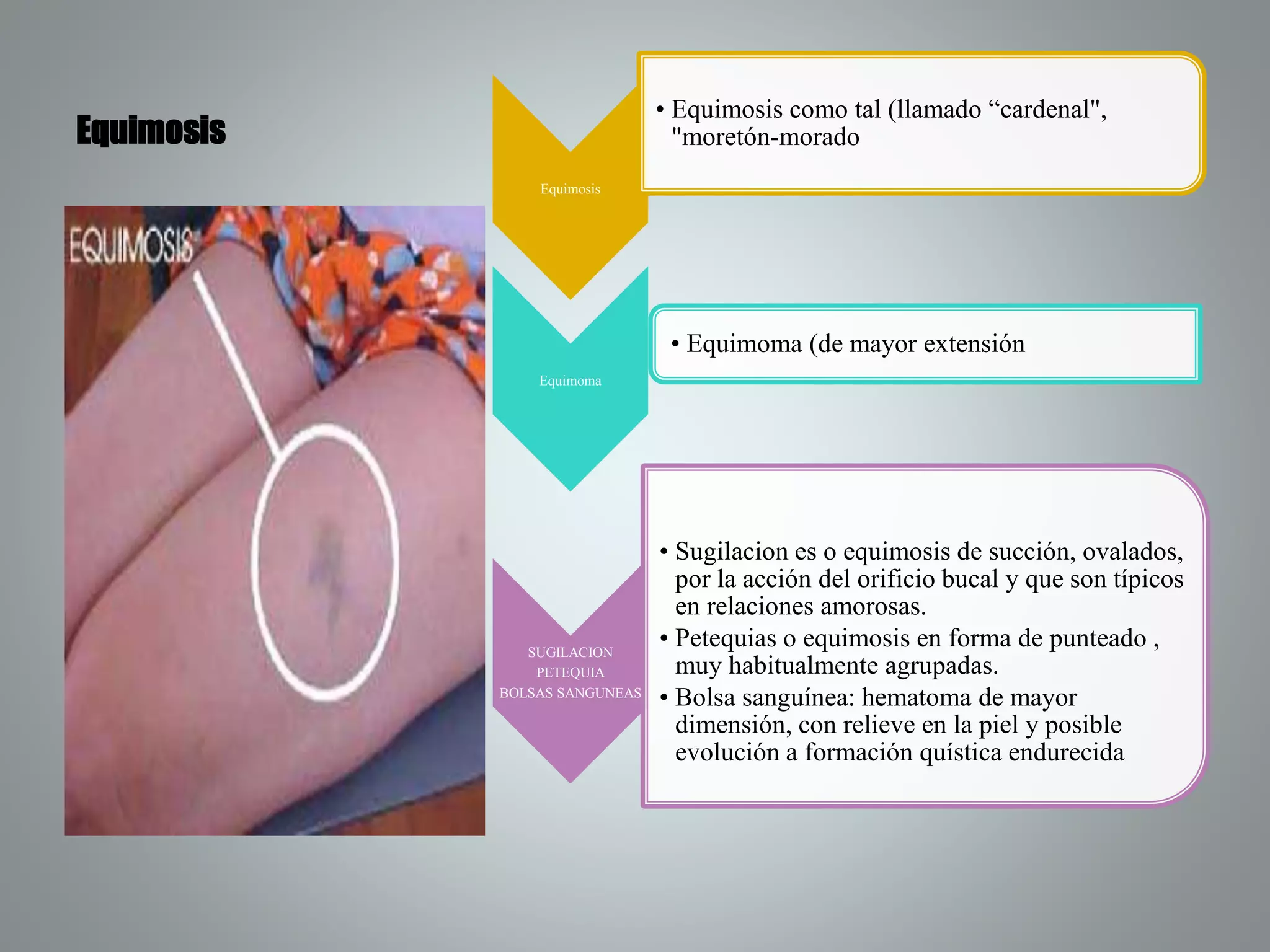 Valoración medico legal de las diferencias entre hematomas | PPTX