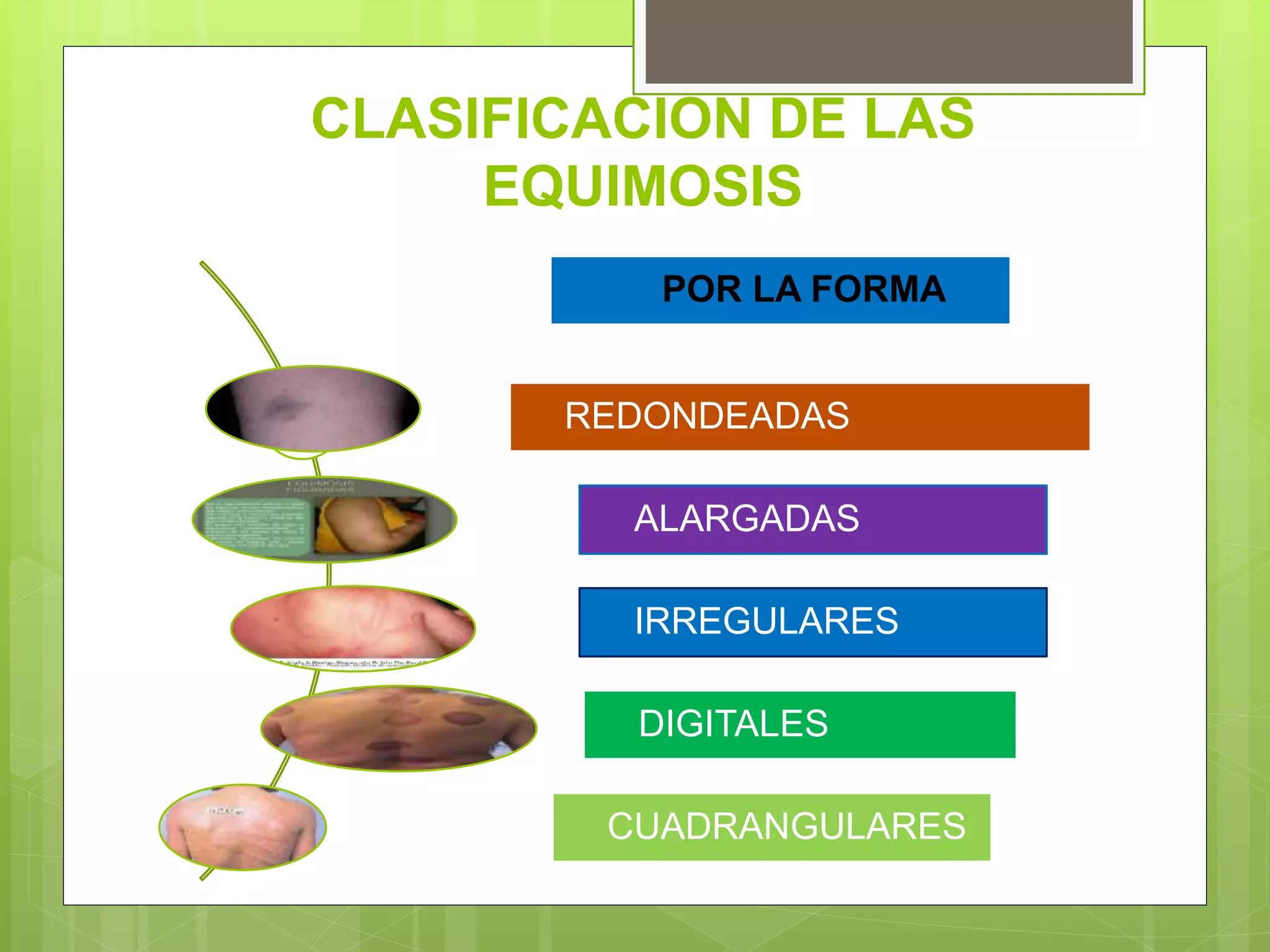 Valoracion medico legal equimosis hematomas | PPTX | Death, Injury, or ...