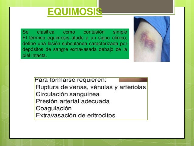 Valoracion medico legal equimosis hematomas