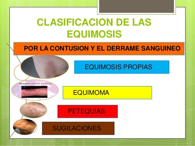 Valoracion medico legal equimosis hematomas